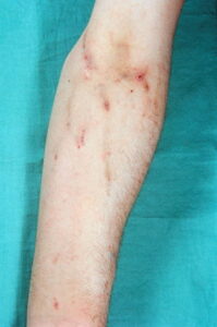 What Do Track Marks Look Like? | Allure Detox