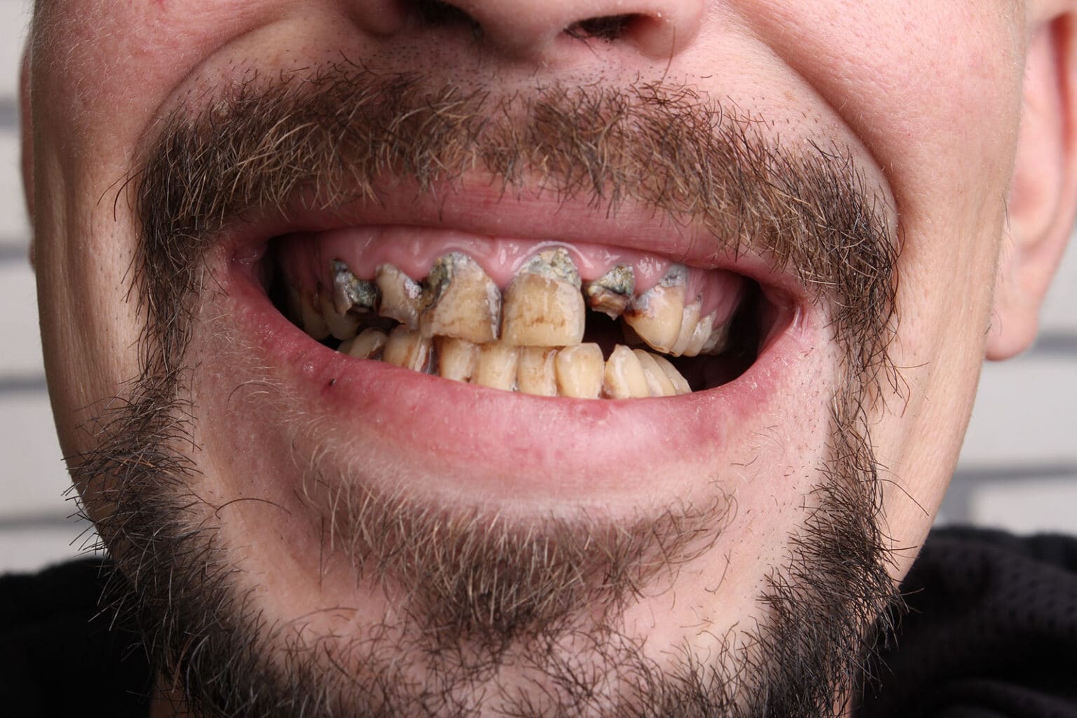 What Drugs Cause Tooth Loss? | Substance Abuse & Oral Health Explained ...